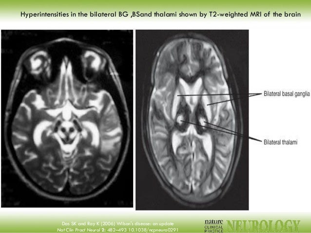 Wilsons Disease Brain Mri