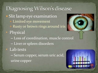 Wilsons disease | PPTX