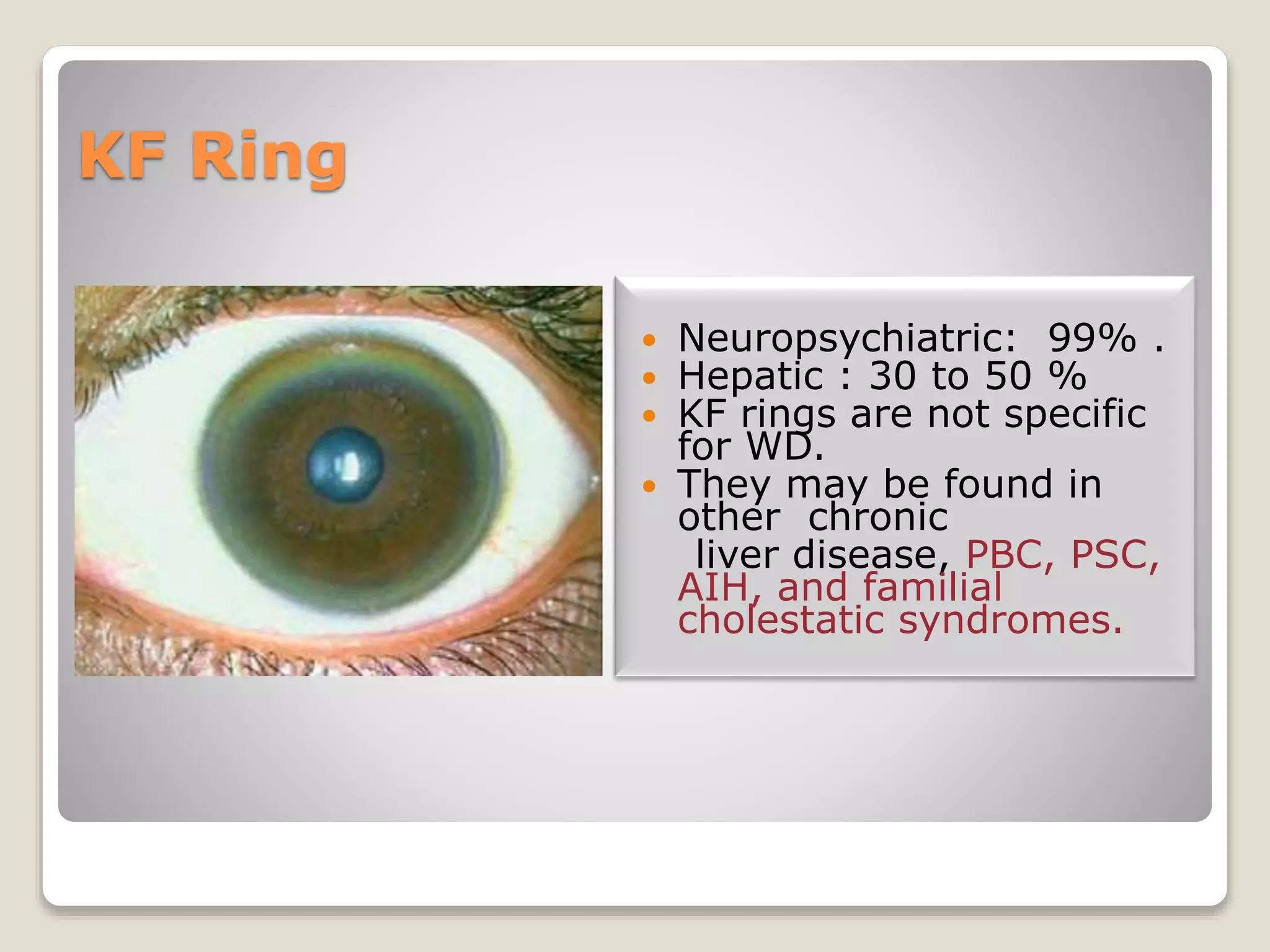Wilson’s disease | PPTX