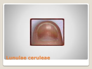 Wilson’s disease | PPTX