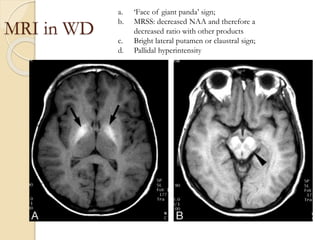 Wilson's disease | PPTX