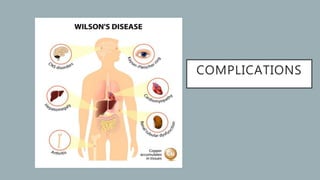 Wilsons disease- A brief medical study. | PPT