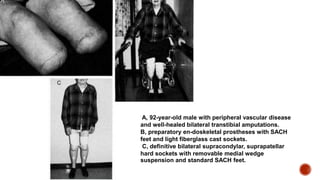 Bilateral amputation | PPTX
