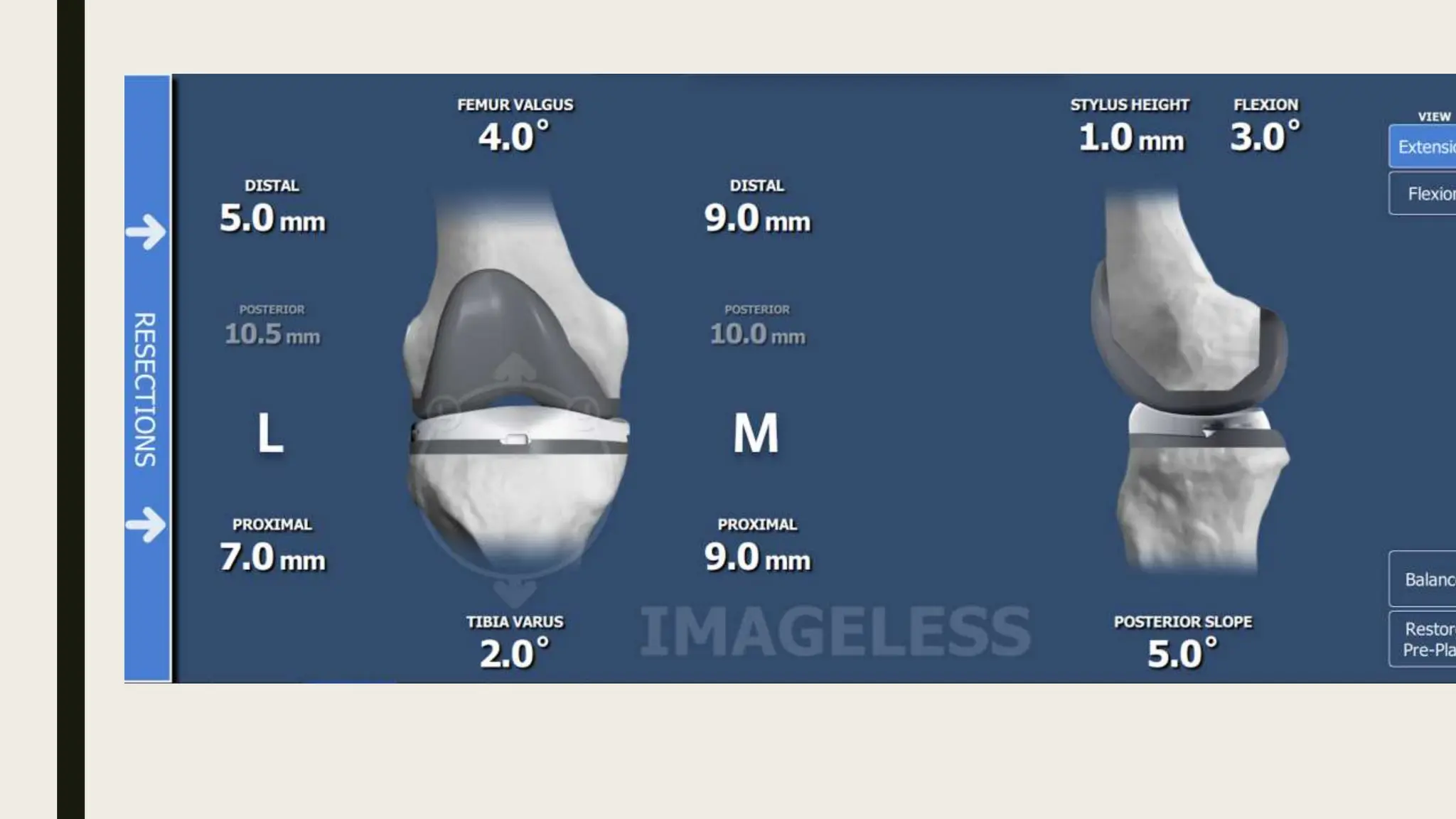 windswept deformity in total knee replacement .pptx