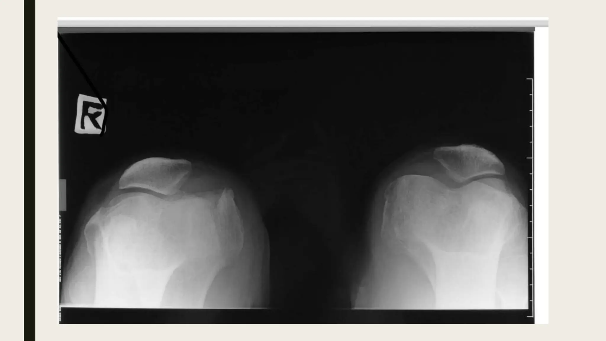windswept deformity in total knee replacement .pptx