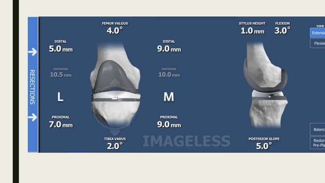 windswept deformity in total knee replacement .pptx | Death, Injury, or ...