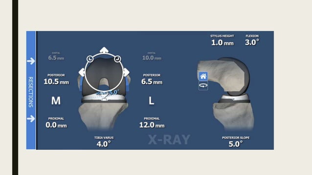 windswept deformity in total knee replacement .pptx