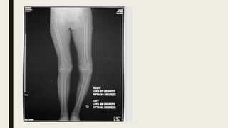 windswept deformity in total knee replacement .pptx