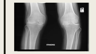 windswept deformity in total knee replacement .pptx