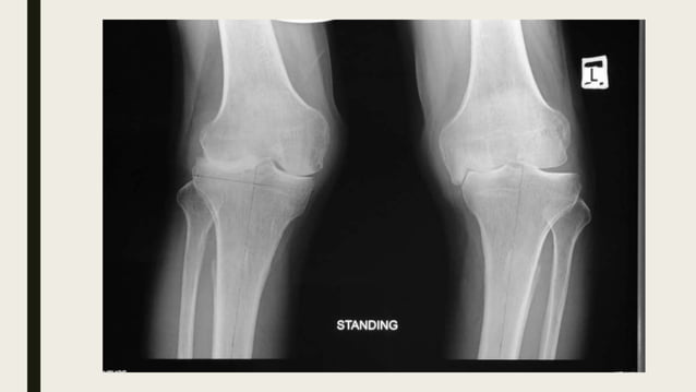 windswept deformity in total knee replacement .pptx