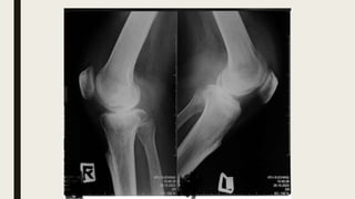windswept deformity in total knee replacement .pptx