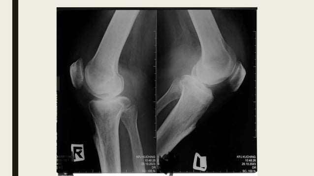 windswept deformity in total knee replacement .pptx