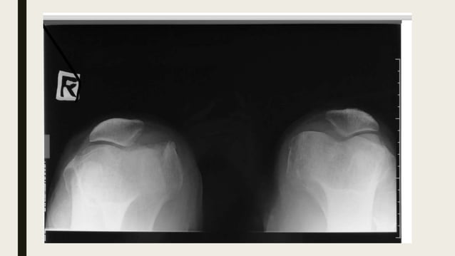 windswept deformity in total knee replacement .pptx