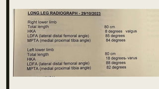 windswept deformity in total knee replacement .pptx