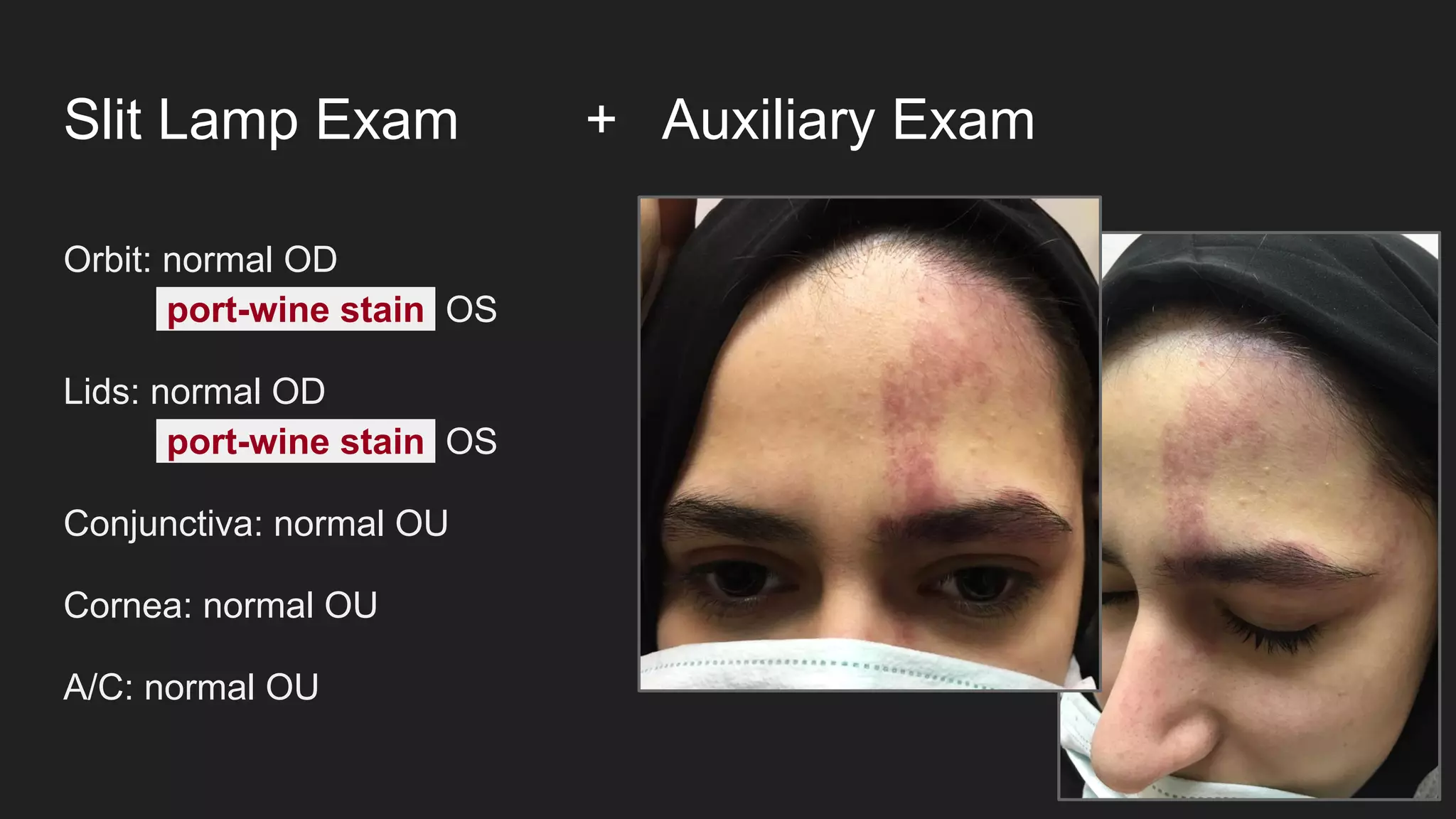 Ophthalmic Manifestations of Sturge Weber Syndrome: A Case Study | PPT