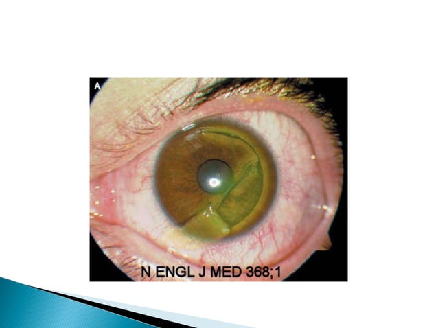 Common eye conditions | PPT