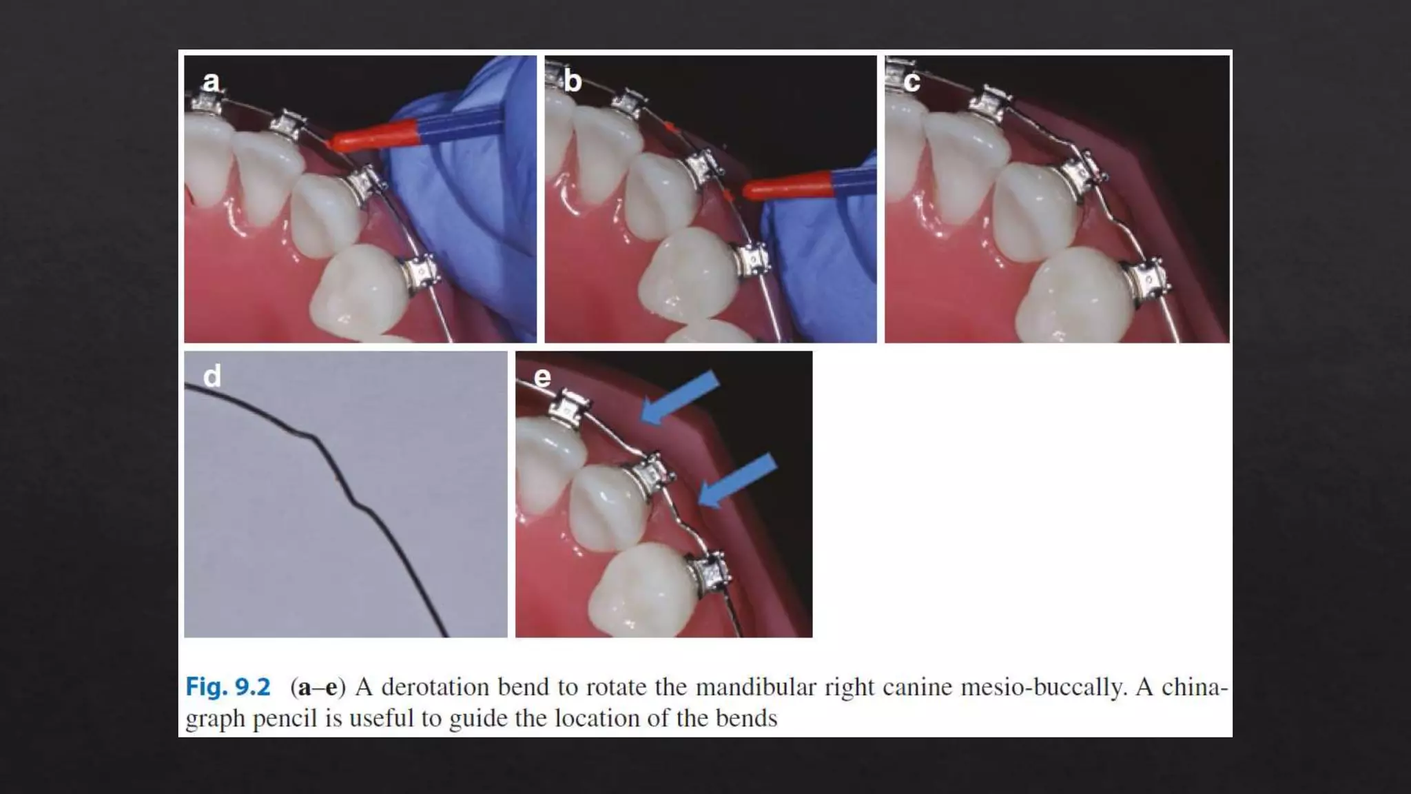 Wire bending in orthodontics (dr nayaungbds phd) | PPTX