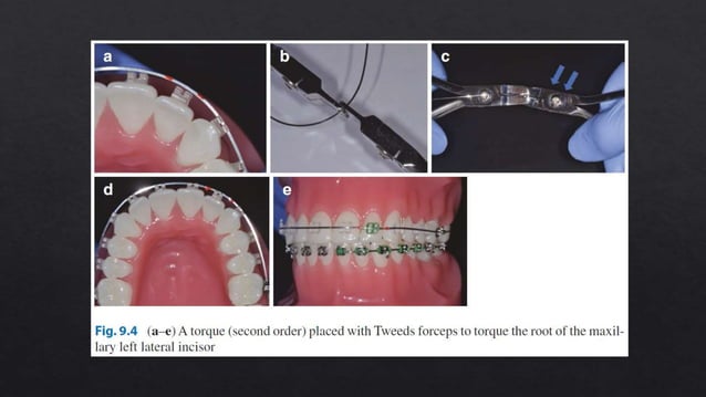 Wire bending in orthodontics (dr nayaungbds phd) | PPTX