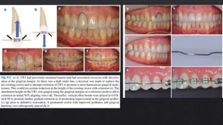 Wire bending in orthodontics (dr nayaungbds phd) | PPTX