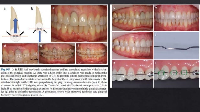 Wire bending in orthodontics (dr nayaungbds phd) | PPTX