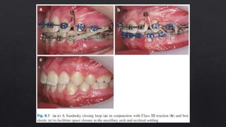 Wire bending in orthodontics (dr nayaungbds phd) | PPTX