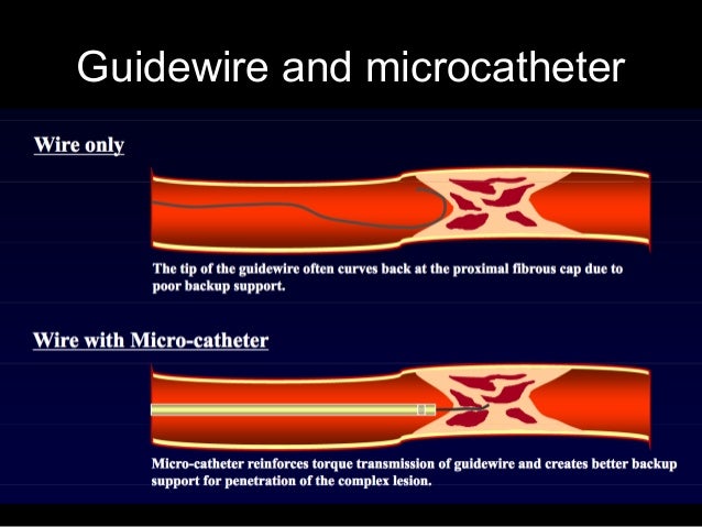 Daniel Weilenmann - Guidewiresand microcatheters: how to use