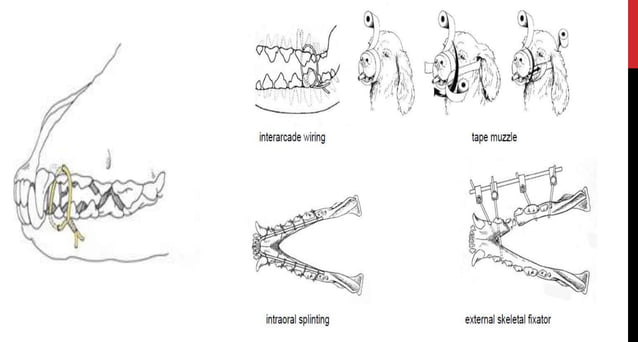 Wiring of-mandible | PPTX