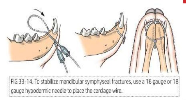 Wiring of-mandible