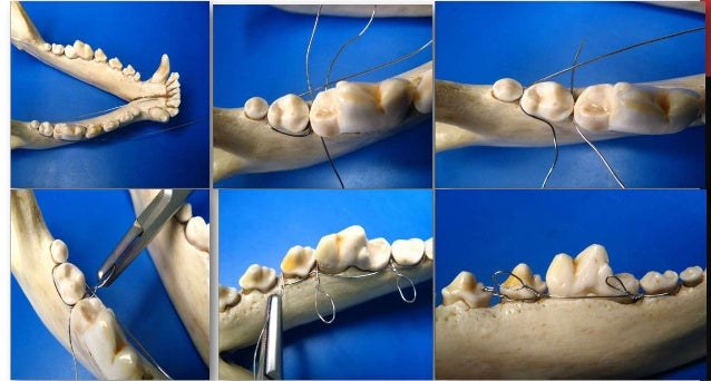 Wiring of-mandible
