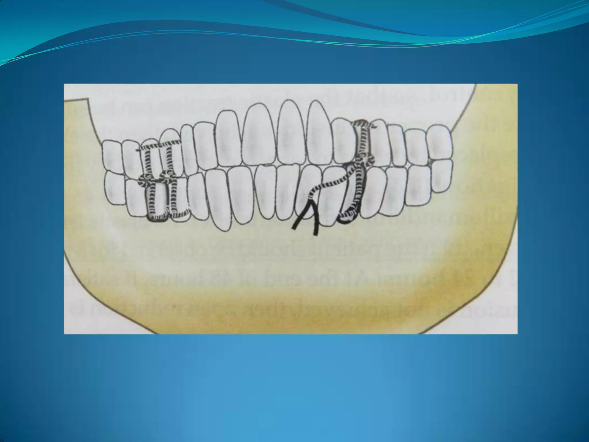 Wiring techniques in maxillofacial surgery | PPTX