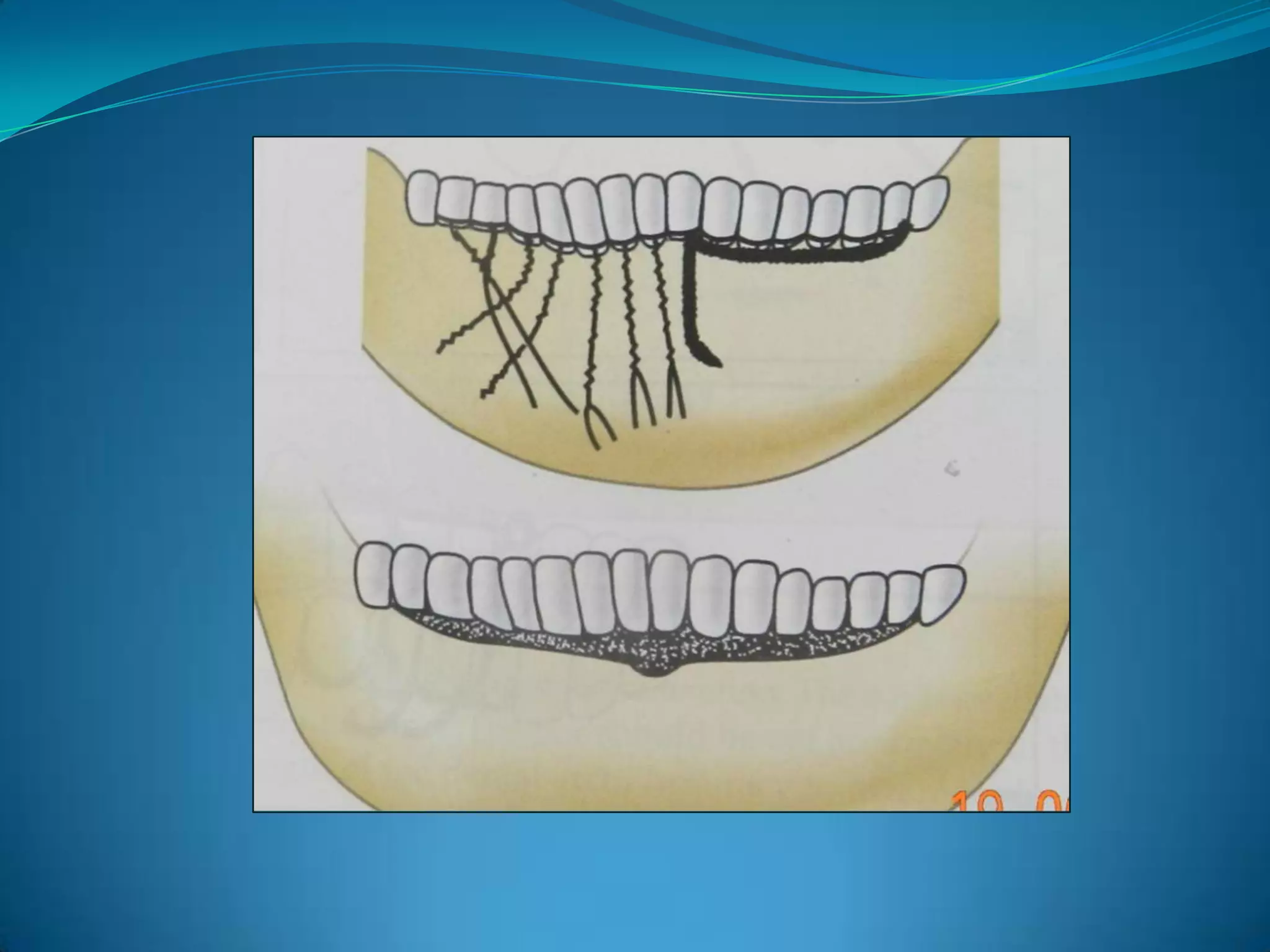 Wiring techniques in maxillofacial surgery | PPTX