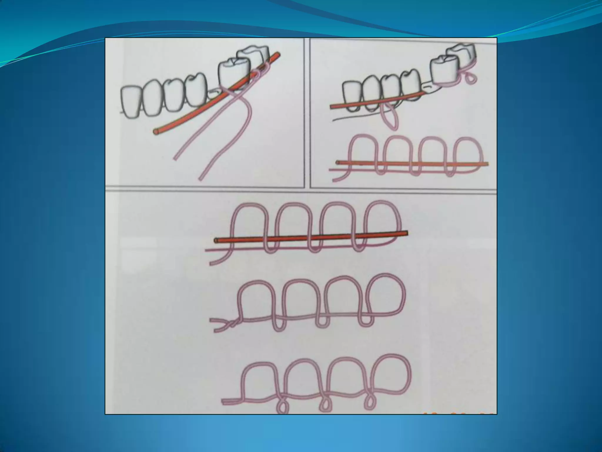 Wiring techniques in maxillofacial surgery | PPTX