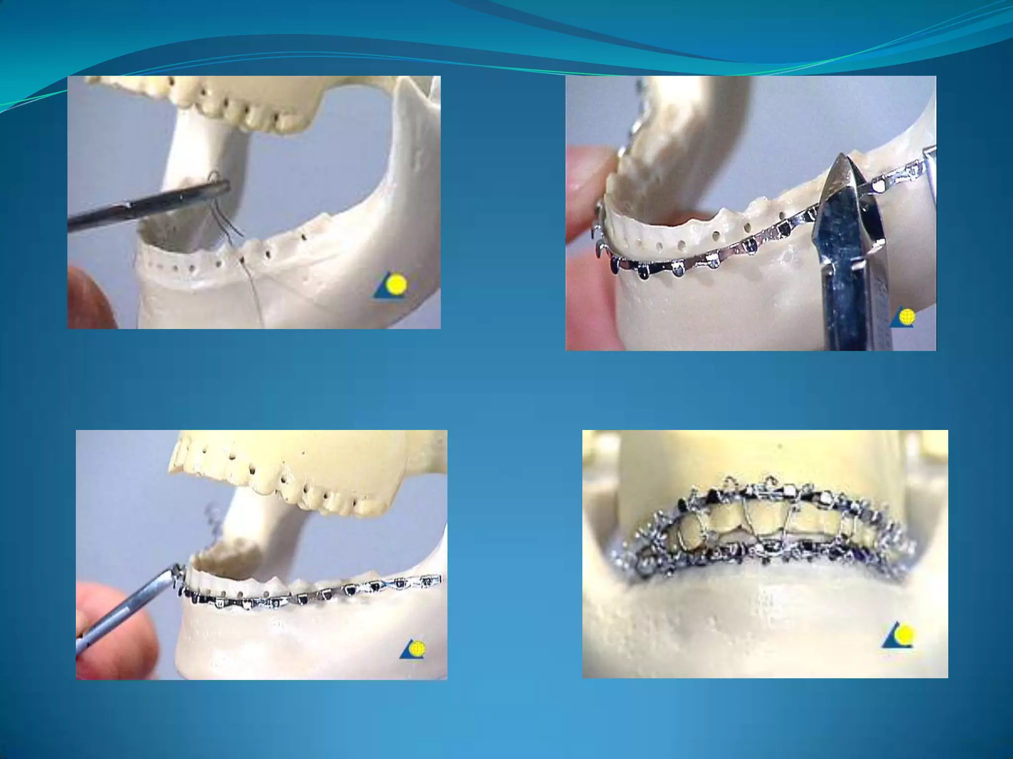 Wiring techniques in maxillofacial surgery | PPTX