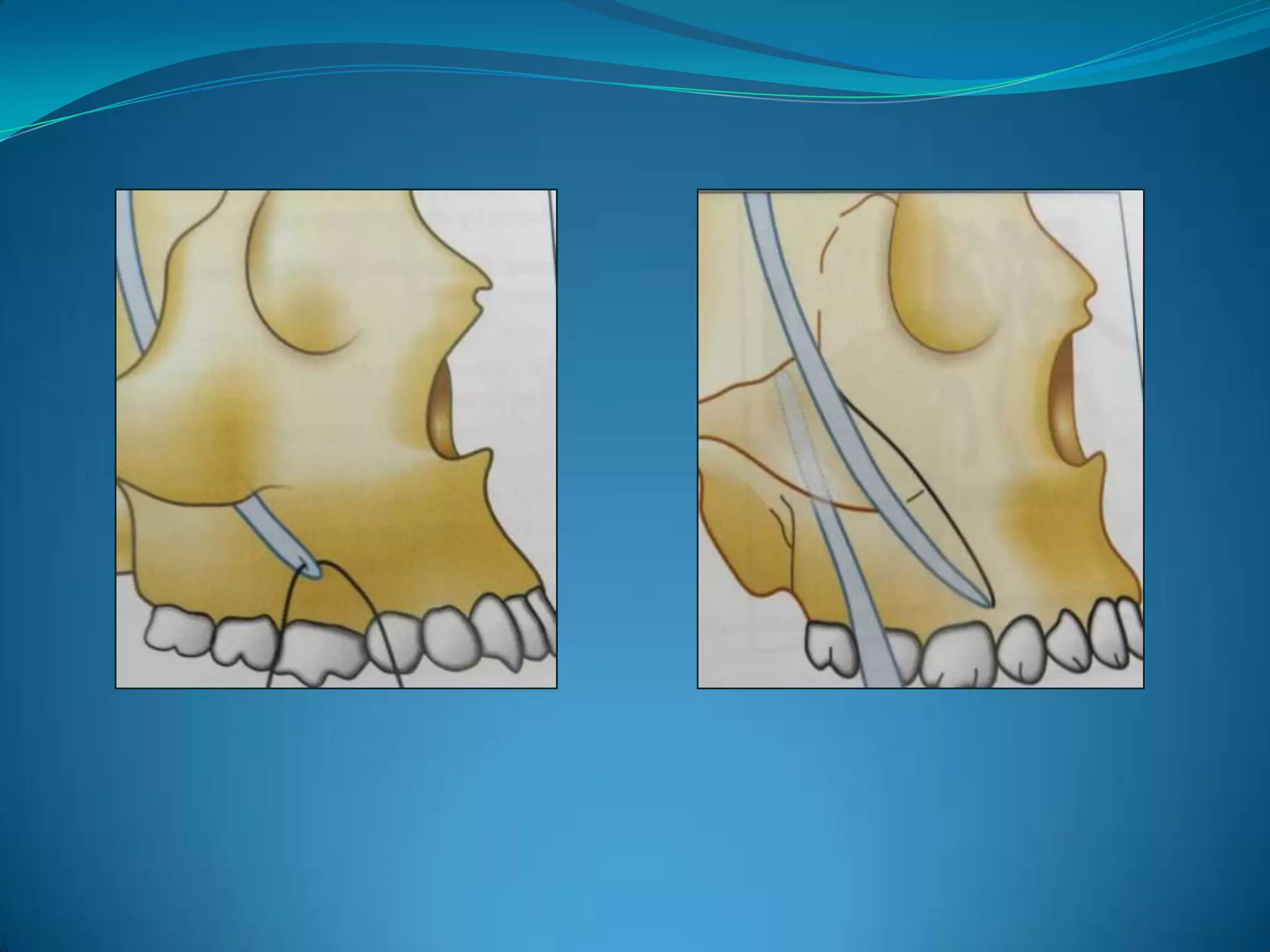 Wiring techniques in maxillofacial surgery | PPTX