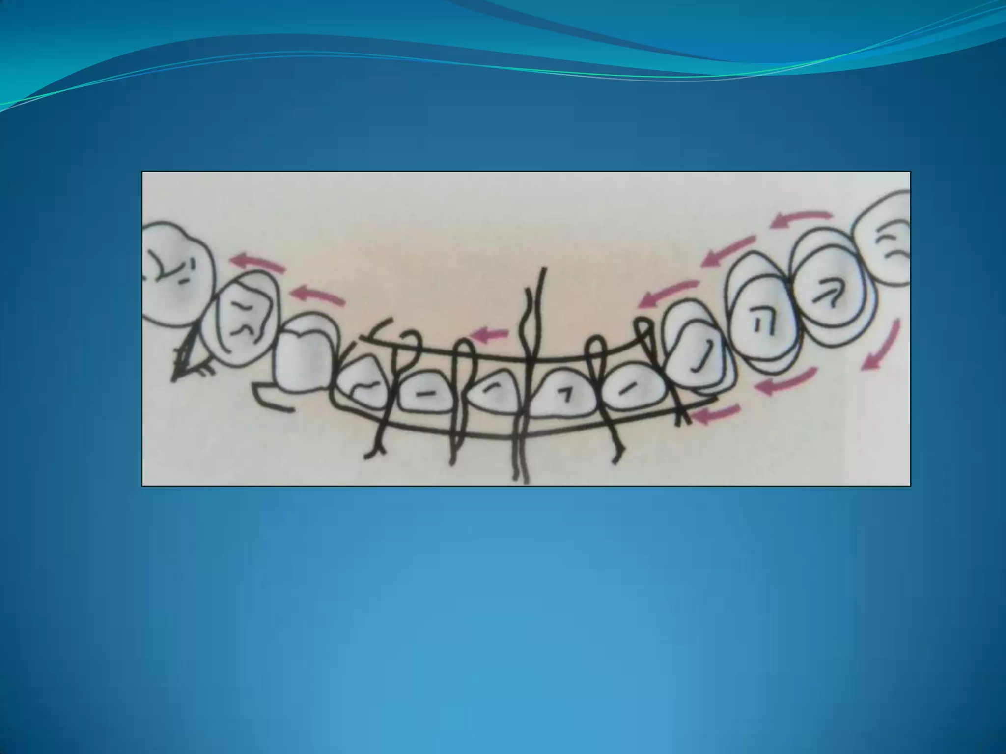 Wiring techniques in maxillofacial surgery | PPTX
