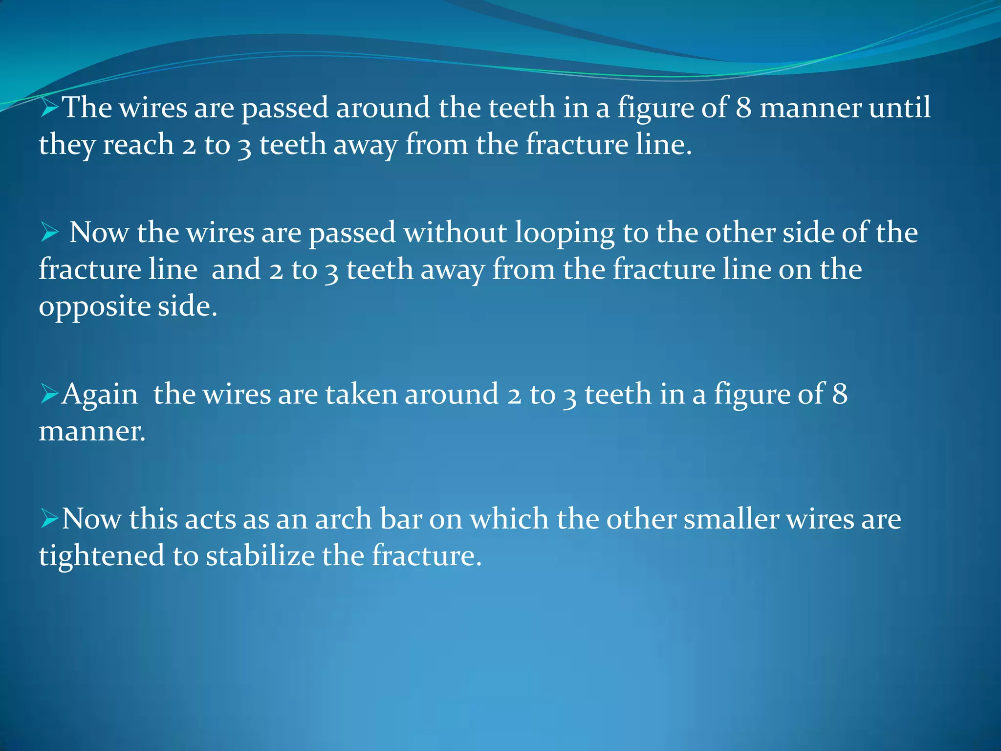 Wiring techniques in maxillofacial surgery | PPTX