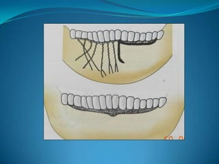 Wiring techniques in maxillofacial surgery | PPTX