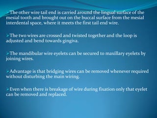 Wiring techniques in maxillofacial surgery | PPTX