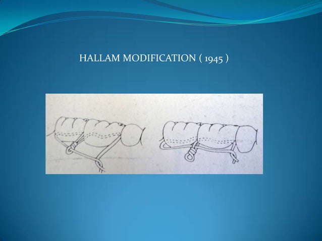 Wiring techniques in maxillofacial surgery | PPTX | Death, Injury, or ...