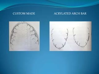 Wiring techniques in maxillofacial surgery | PPTX