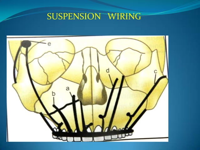 Wiring techniques in maxillofacial surgery | PPTX | Death, Injury, or ...