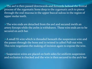 Wiring techniques in maxillofacial surgery | PPTX
