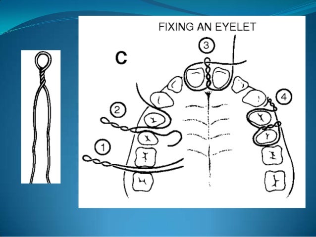 Wiring techniques in maxillofacial surgery