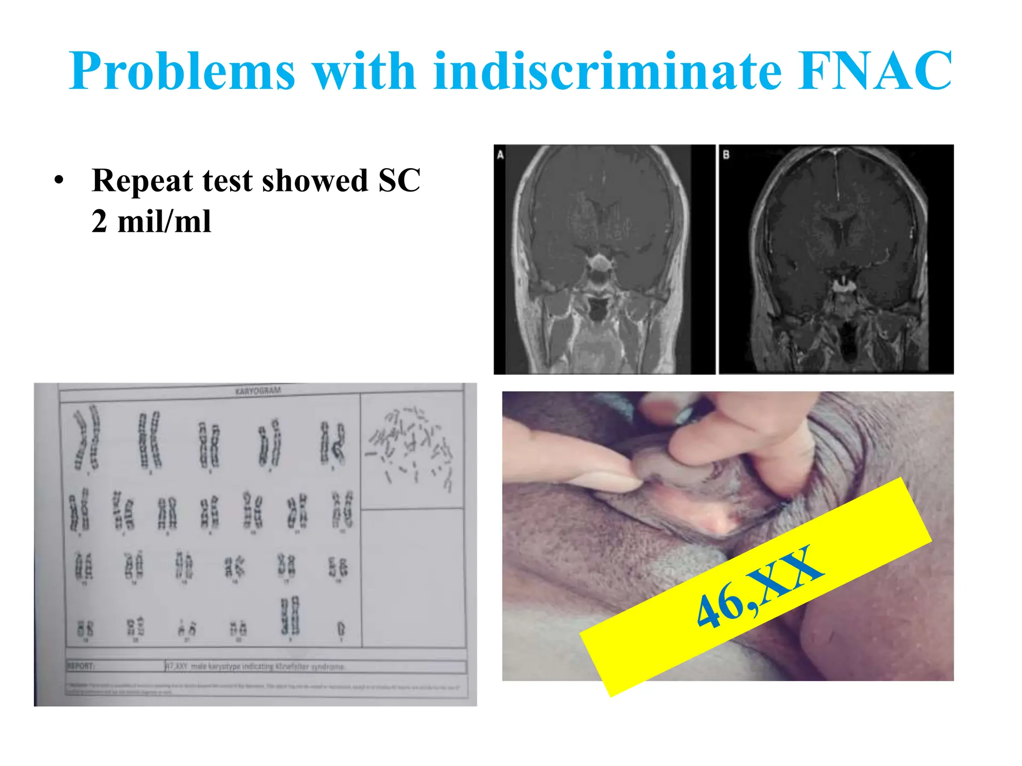 Approach to abnormal semen analysis- way forward | PPTX