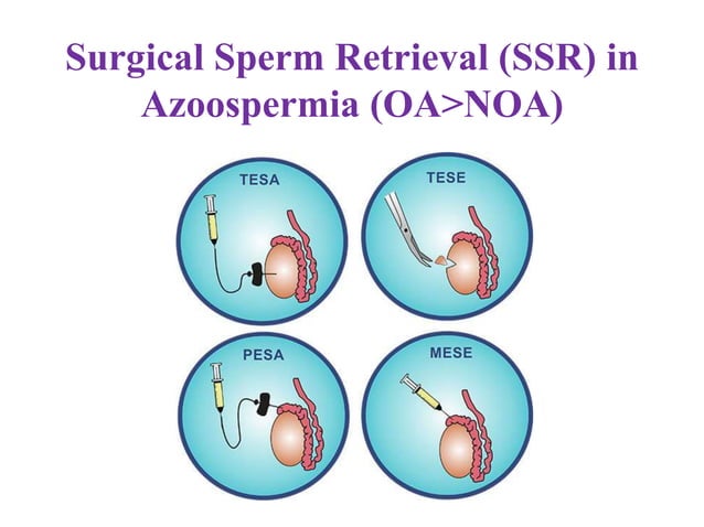 Approach to abnormal semen analysis- way forward | PPTX | Infertility ...