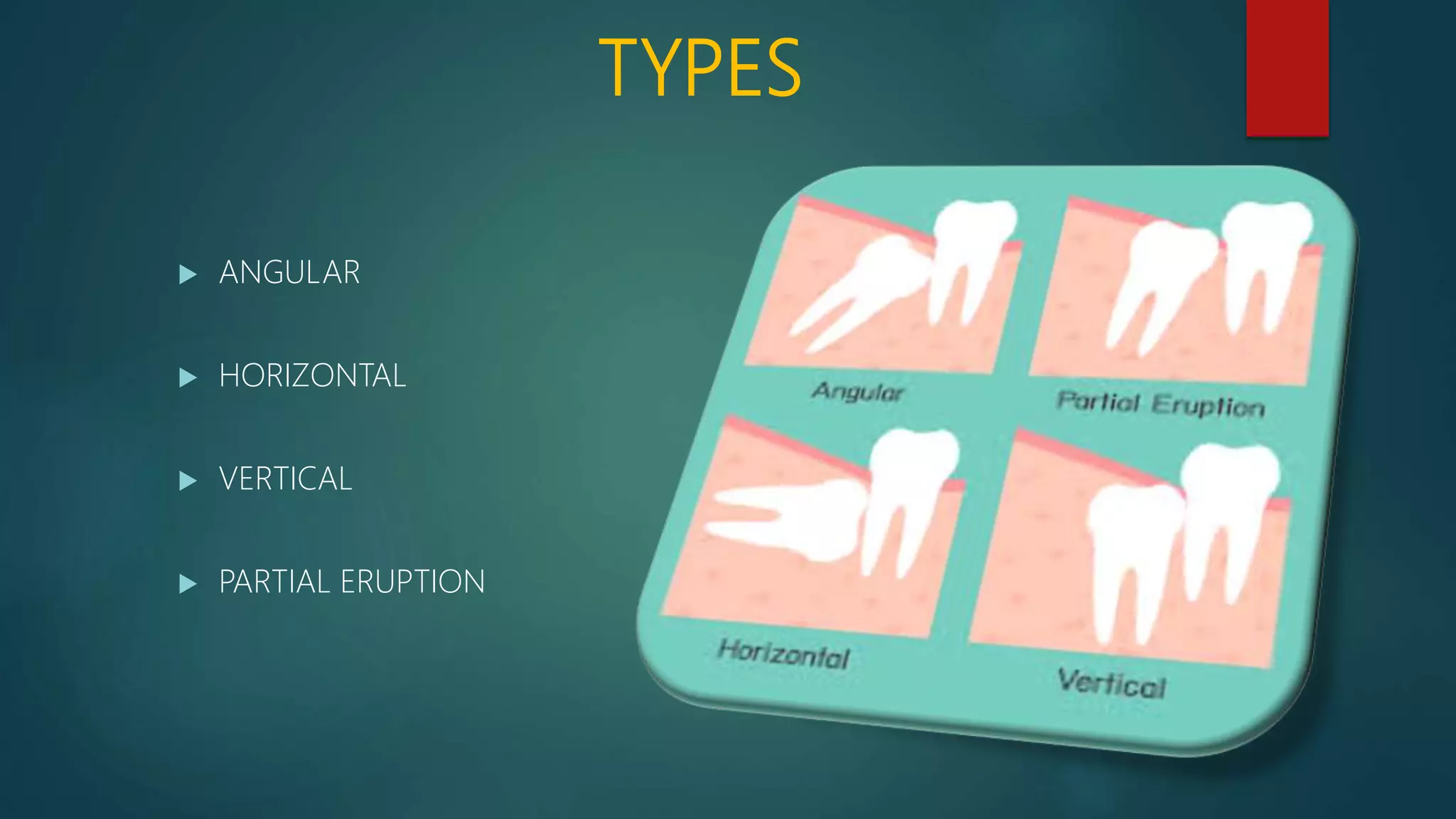 Wisdom teeth | PPT