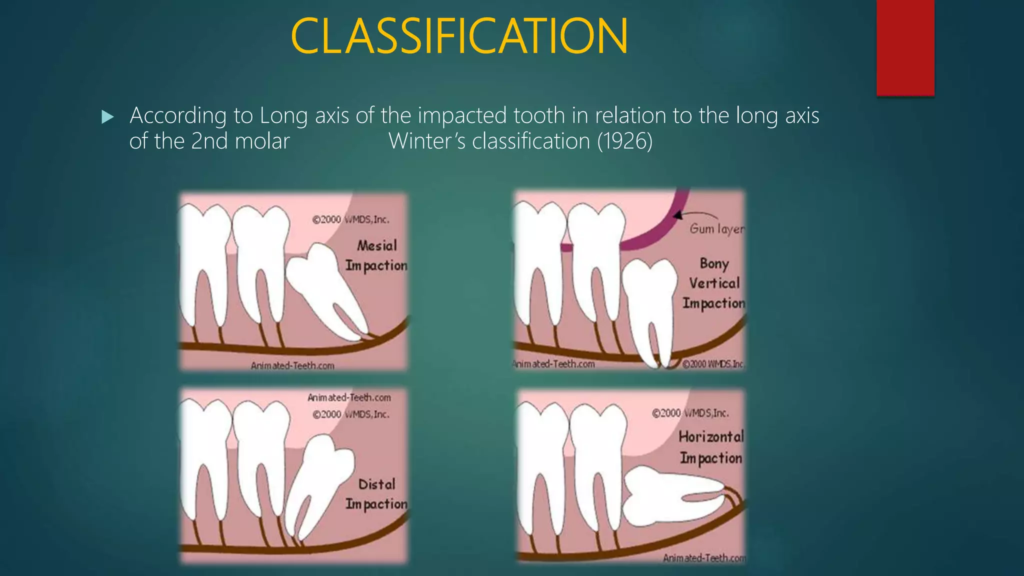 Wisdom teeth | PPT