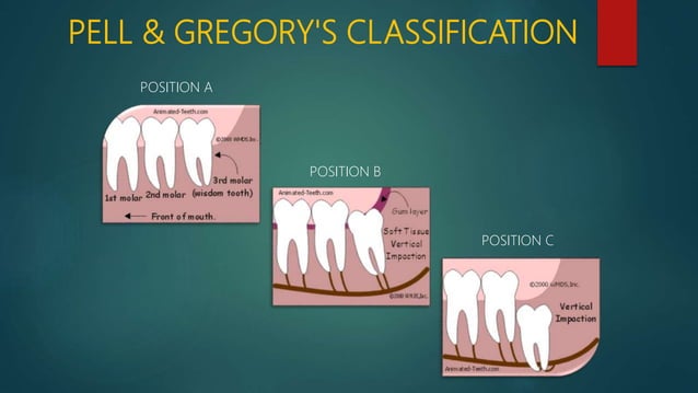 Wisdom teeth | PPT