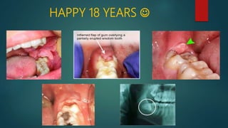 Wisdom teeth | PPT