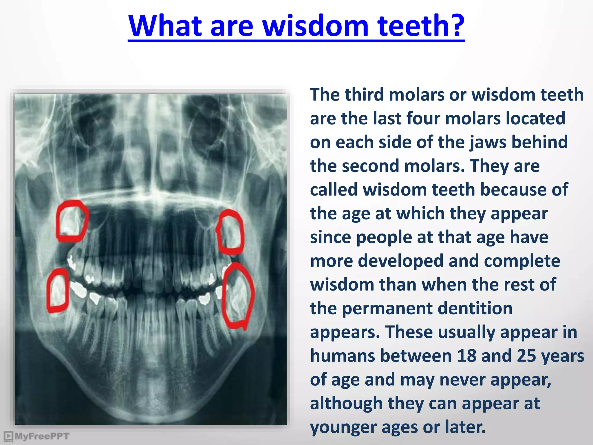 Wisdom teeth | PDF